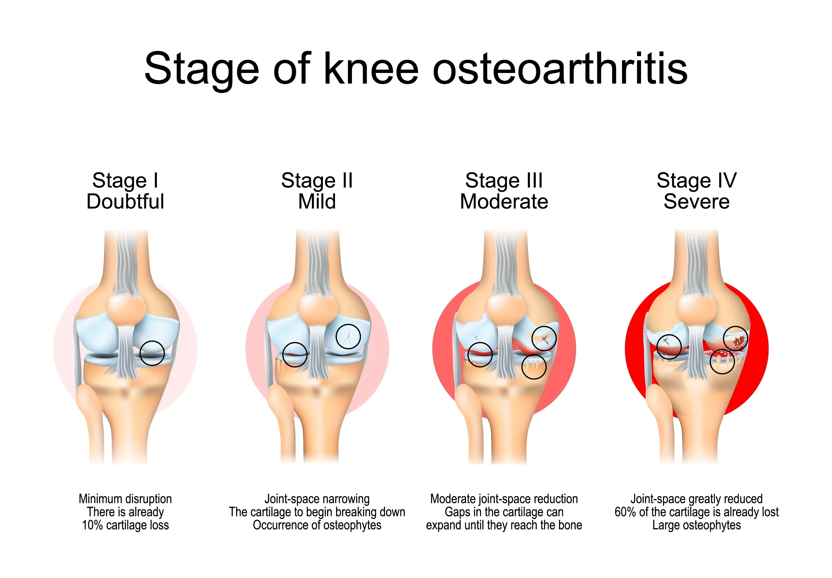Osteoarthritis (Knee Joints)